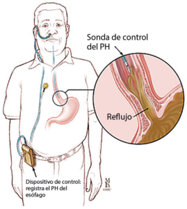 Phmetría Esofágica de 24 horas: Diagnóstico preciso para el reflujo ...